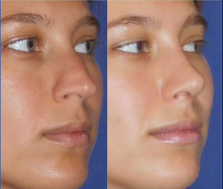 Dr. Gabriel Mirave Rinoplastía